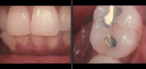 Refurbished Digidoc Intraoral Camera- Sodium Dental