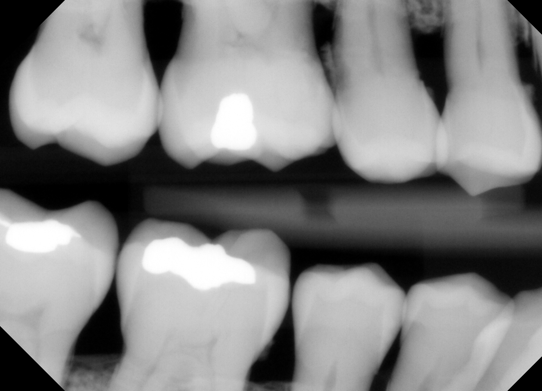 Clio Digital XRay Sensor - Direct To USB Ultra High Resolution