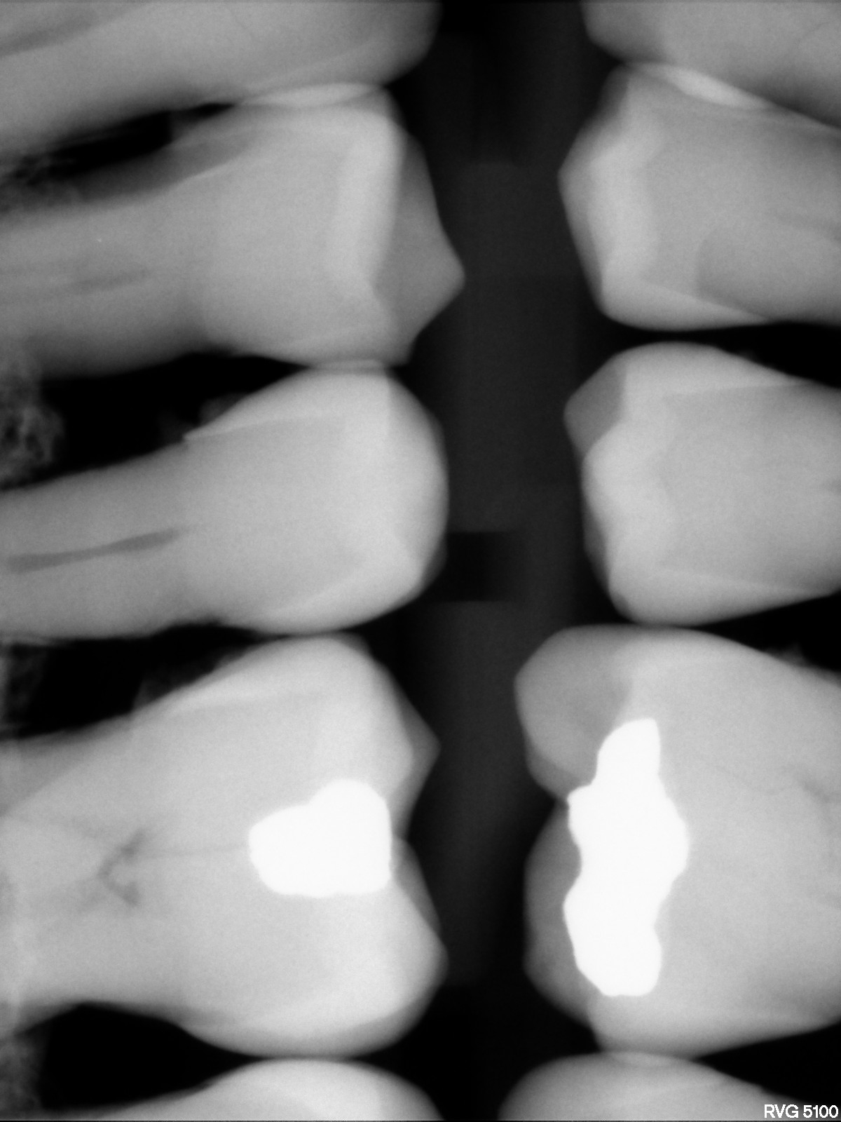 Refurbished Kodak RVG 6100 Size 2-Sodium Dental