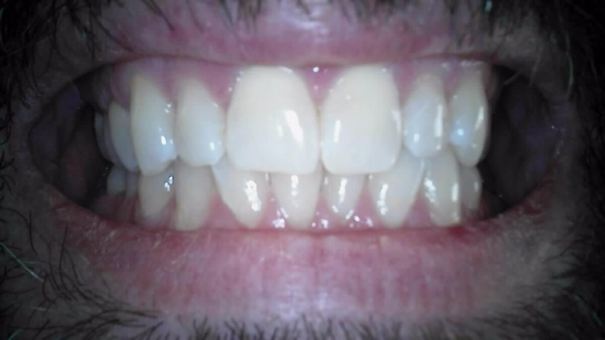 Dual Alpha Dental Camera