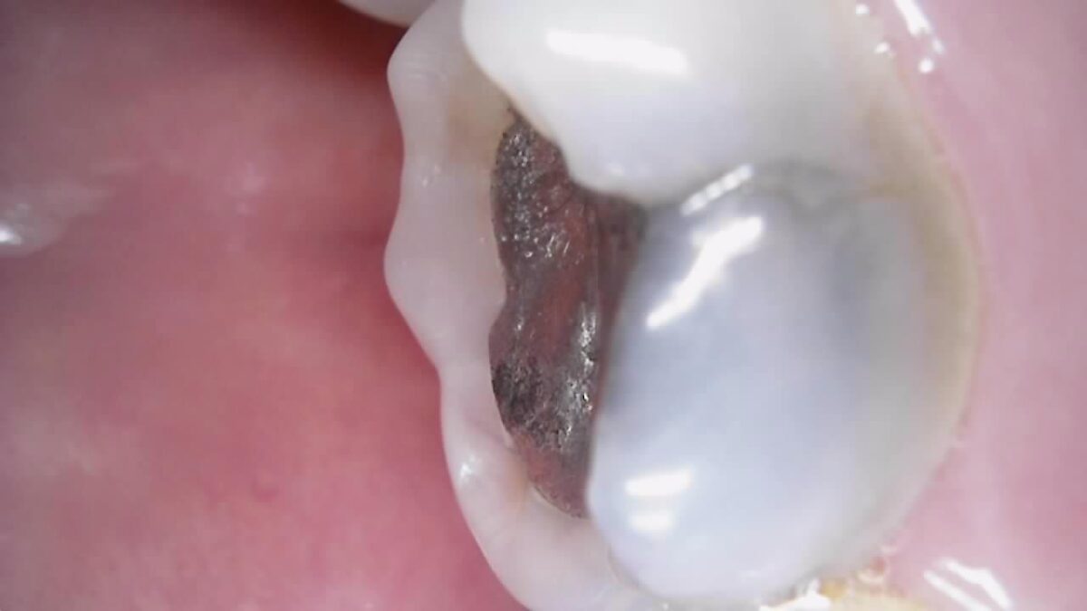 Dual Alpha Dental Camera